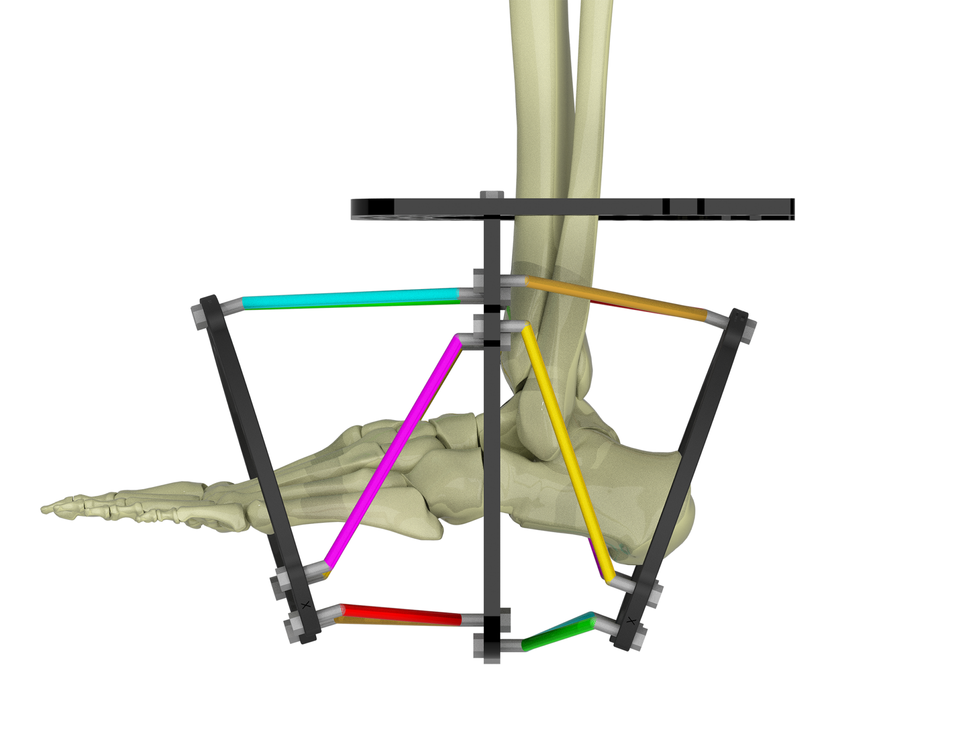 Techniques in Deformity Correction - Compendium of TSF Applications