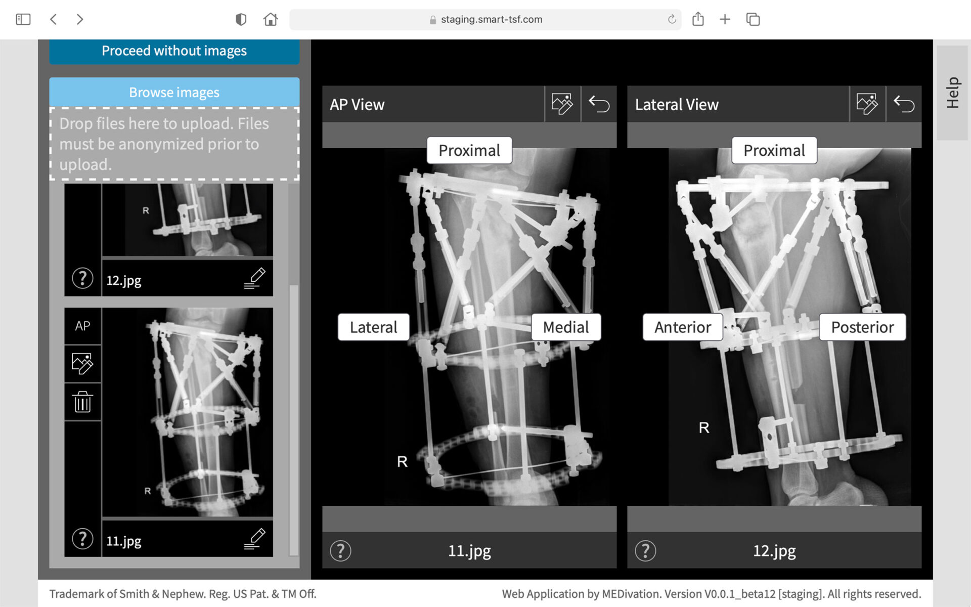 Techniques in Deformity Correction - Compendium of TSF Applications