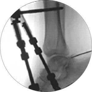 Techniques in Deformity Correction - Compendium of TSF Applications