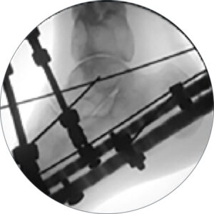 Techniques in Deformity Correction - Compendium of TSF Applications